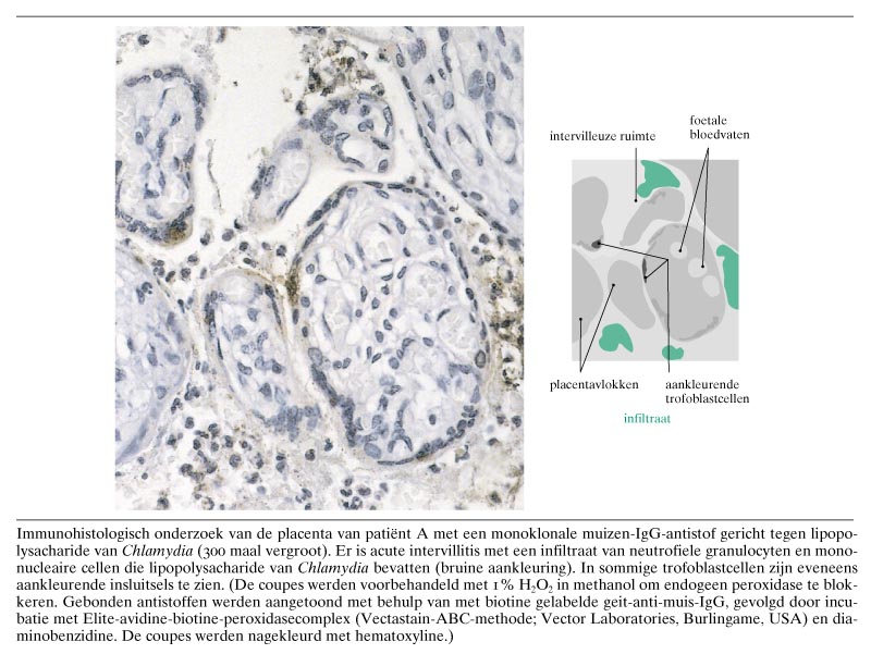 Lammerende schapen als bron van ernstige psittacose bij een zwangere ...