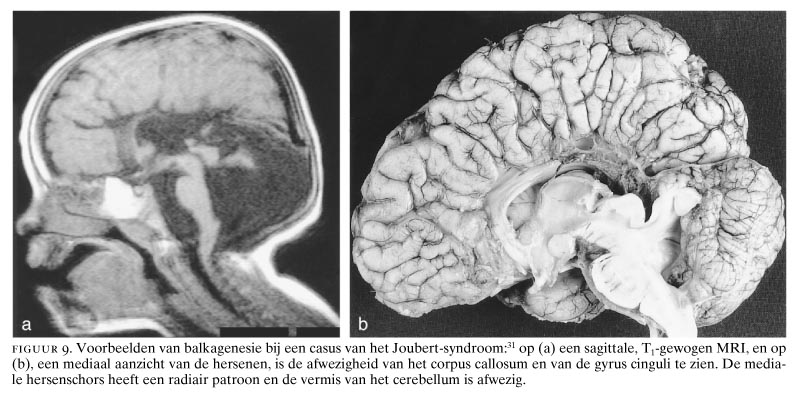 Lissencefalie Hersenen Corticale Dysplasie Kinderneurologie