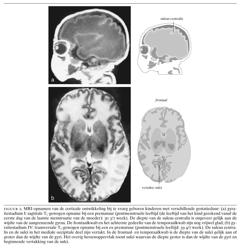Beeldvorming van de hersenontwikkeling bij te vroeg geborenen | NTVG