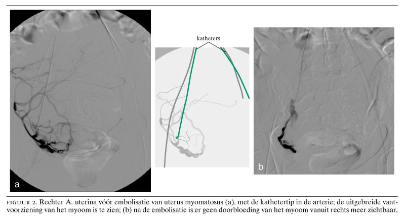 Embolisatie van de A. uterina: een nieuwe behandeling bij uterus ...