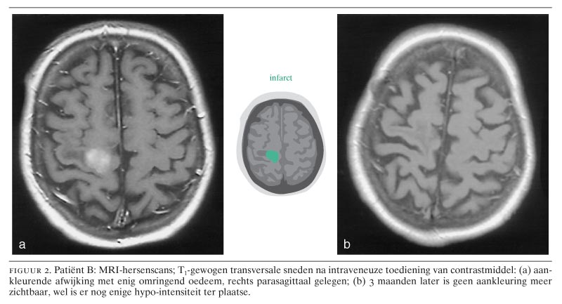 Beroerte Hersenen Mri Een Beroerte (CVA) Slingeland Ziekenhuis