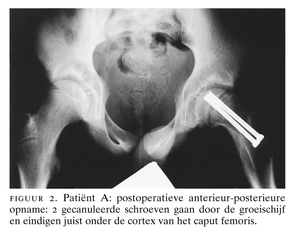 Pijn- en loopklachten bij 3 (bijna-)pubers met een afgegleden heupkop ...