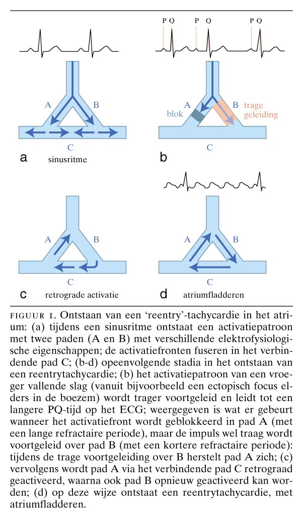 Behandeling van een intra-atriale 'reentry'-tachycardie door ...
