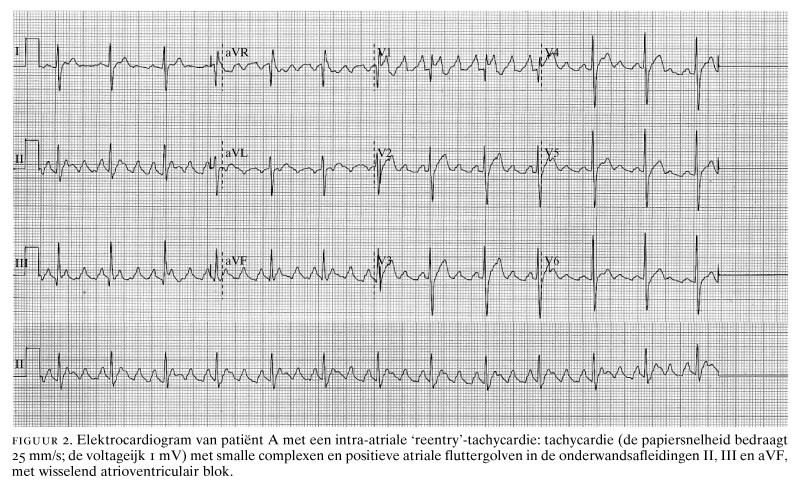 Behandeling van een intra-atriale 'reentry'-tachycardie door ...