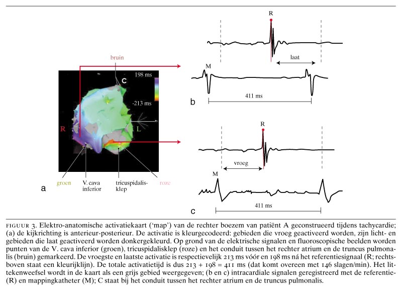 Behandeling van een intra-atriale 'reentry'-tachycardie door ...