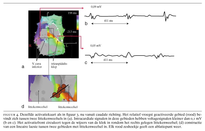 Behandeling van een intra-atriale 'reentry'-tachycardie door ...