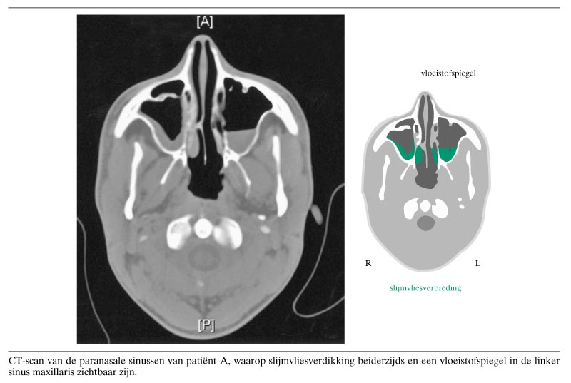 Sinusitis als hoofdoorzaak van koorts bij de beademde patiënt | NTvG