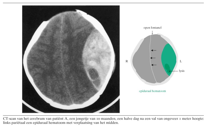Drie zuigelingen met een epiduraal hematoom | Nederlands Tijdschrift ...