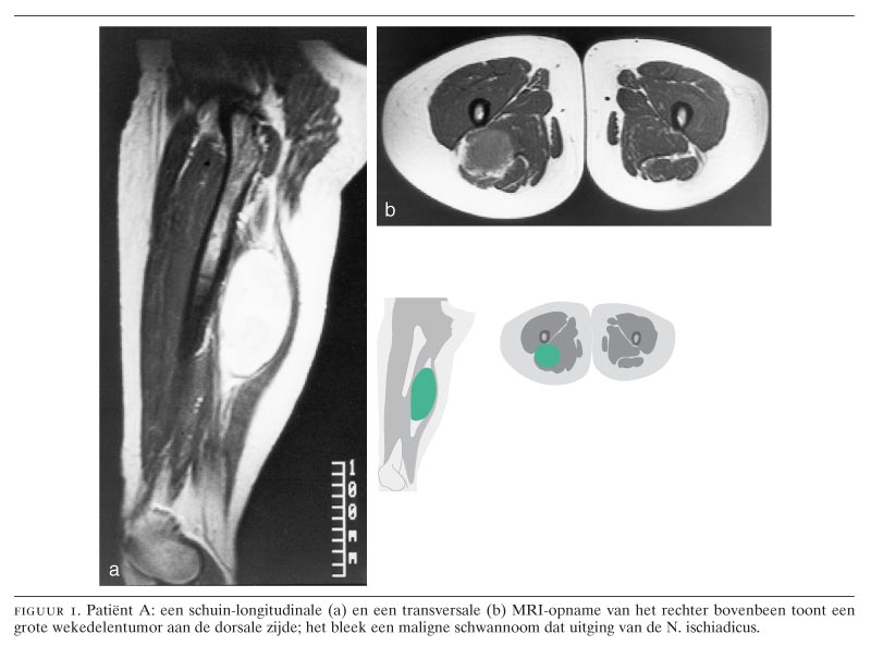 Resectie van de N. ischiadicus met behoud van beenfunctie | NTvG