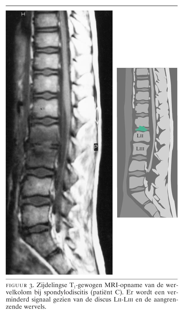 (Spondylo)discitis bij 3 kinderen; differentiaaldiagnose en behandeling ...