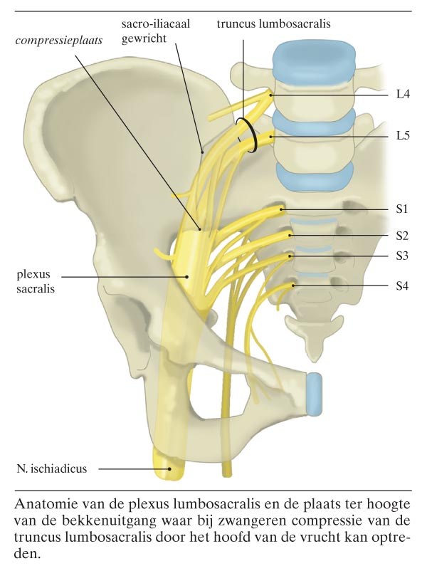 Klapvoet tijdens zwangerschap of bevalling door obstetrische ...