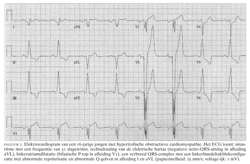 Hypertrofische cardiomyopathie: een genetisch overdraagbare hartziekte ...