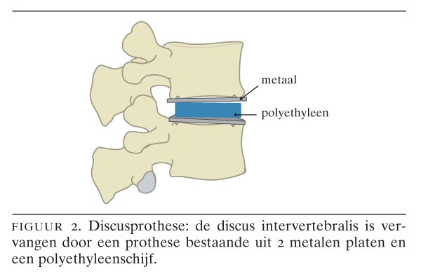 De discusprothese: mythen en feiten | Nederlands Tijdschrift voor ...