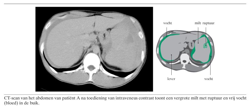 Conservatieve behandeling van een spontane miltruptuur bij een patiënt ...