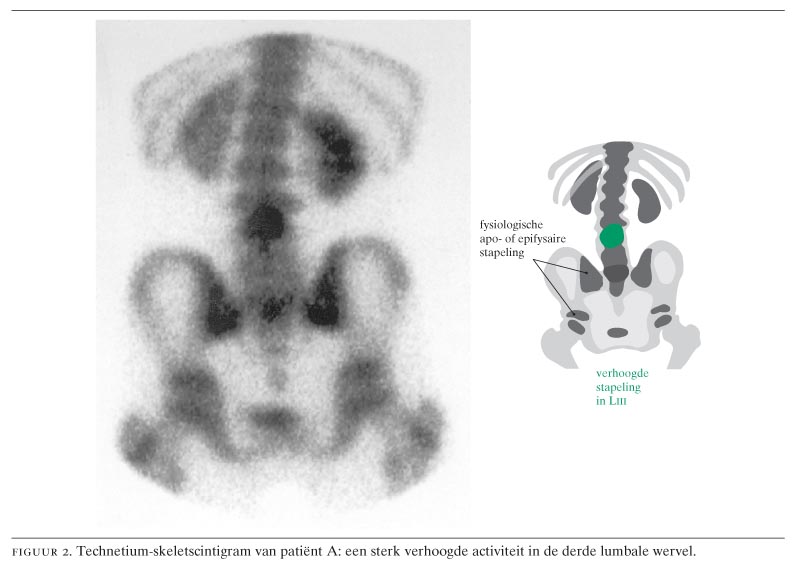 Te jong voor een pijnlijke scheve rug | NTvG