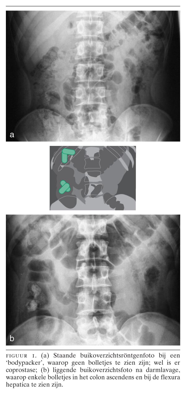 Niet-fatale ruptuur van een cocaïnebolletje bij een man met 'bodypacker ...