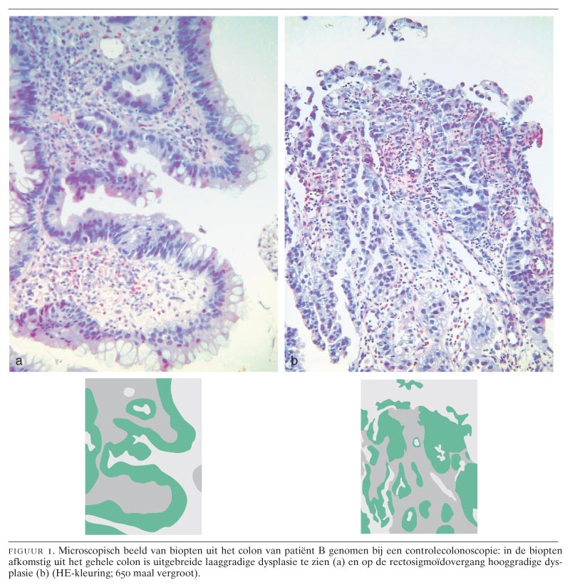 De maligne kant van chronisch inflammatoir darmlijden | NTvG