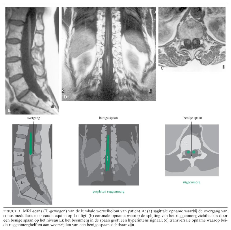 Pijn in de benen en progressieve neurologische uitval: gekluisterd ...