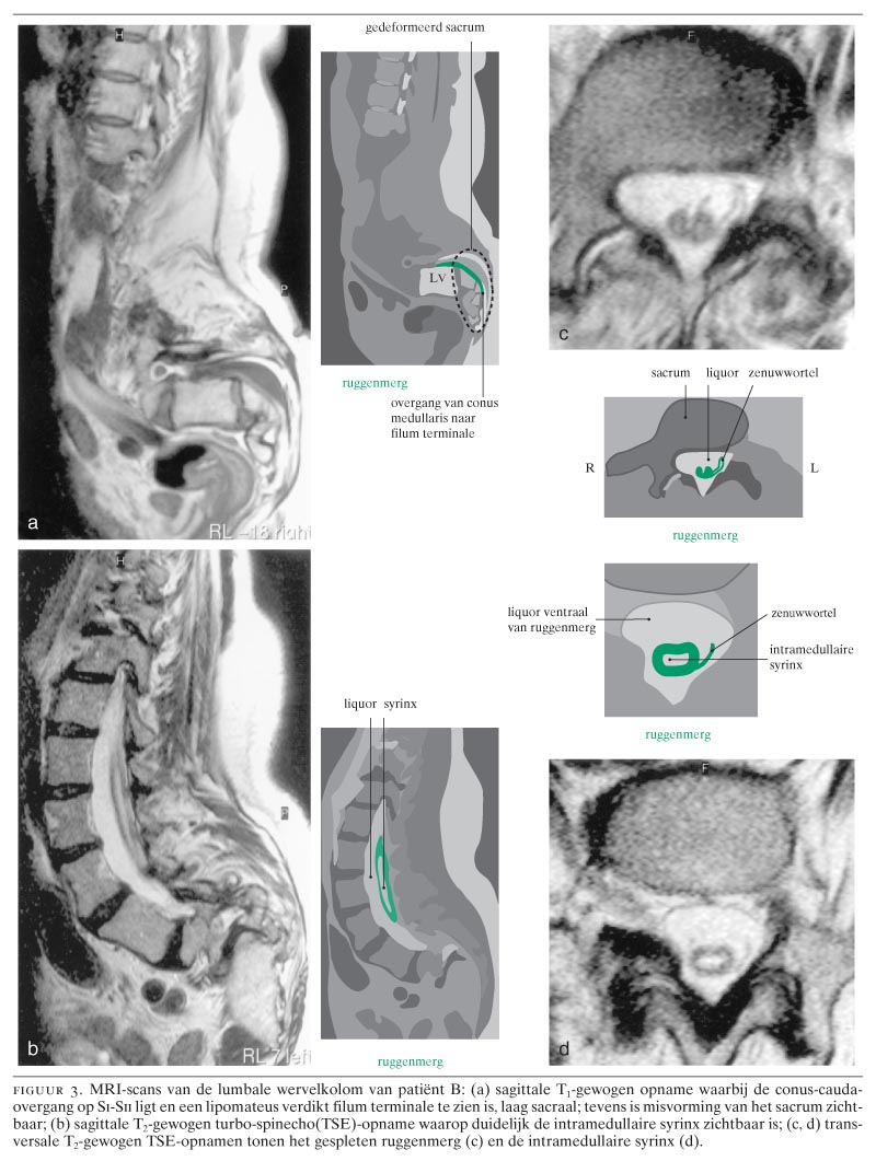 Pijn in de benen en progressieve neurologische uitval: gekluisterd ...