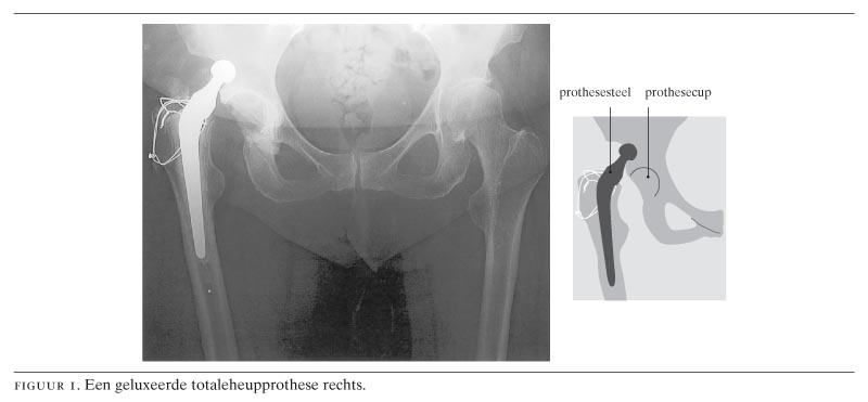 Luxatie van totaleheupprothese; risicofactoren en behandeling | NTVG