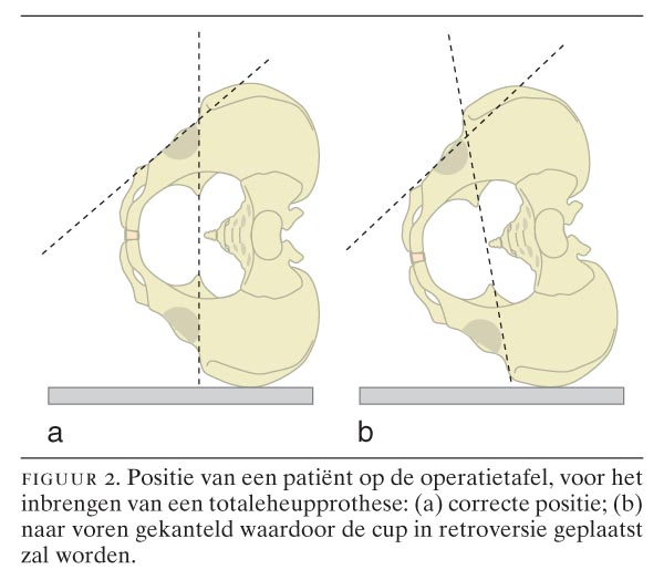 Luxatie van totaleheupprothese; risicofactoren en behandeling | NTVG