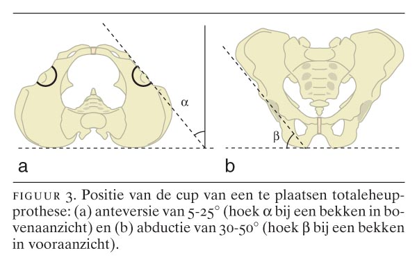 Luxatie van totaleheupprothese; risicofactoren en behandeling | NTVG