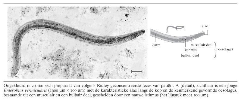 Hevige diarree en eosinofiele colitis toegeschreven aan aarsmaden ...
