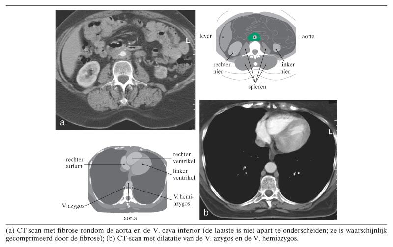 Diagnose in beeld (140). Een vrouw met trombosebenen | Nederlands ...