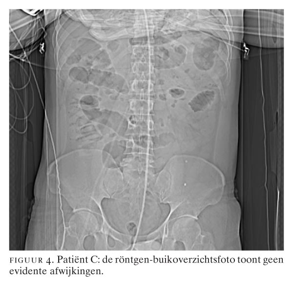 'Bodypacker'-syndroom: een importziekte met forensisch-geneeskundige ...
