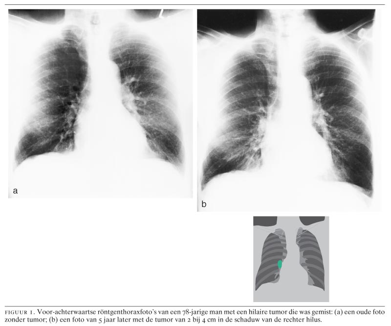 De beperkte detectie van longkanker op röntgenfoto's van de thorax | NTVG