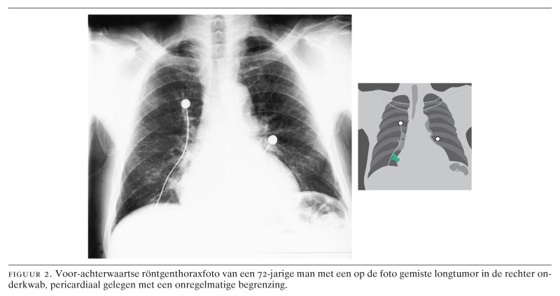 De beperkte detectie van longkanker op röntgenfoto's van de thorax | NTVG