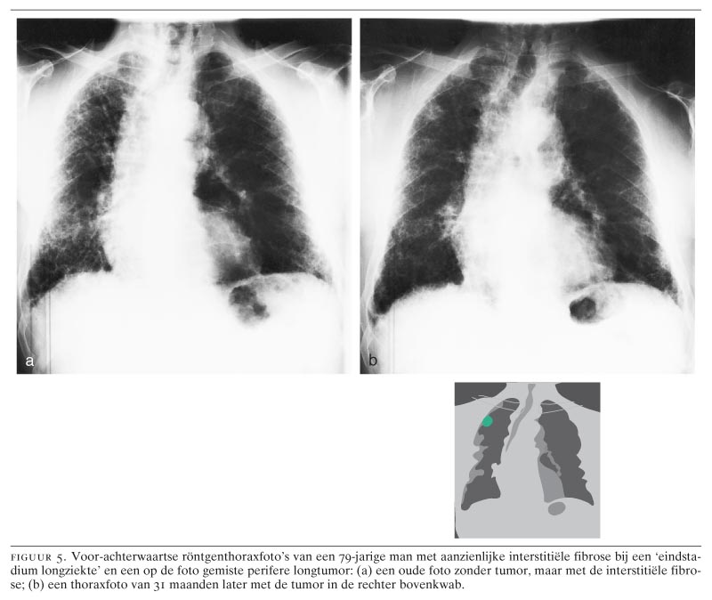 De beperkte detectie van longkanker op röntgenfoto's van de thorax | NTVG