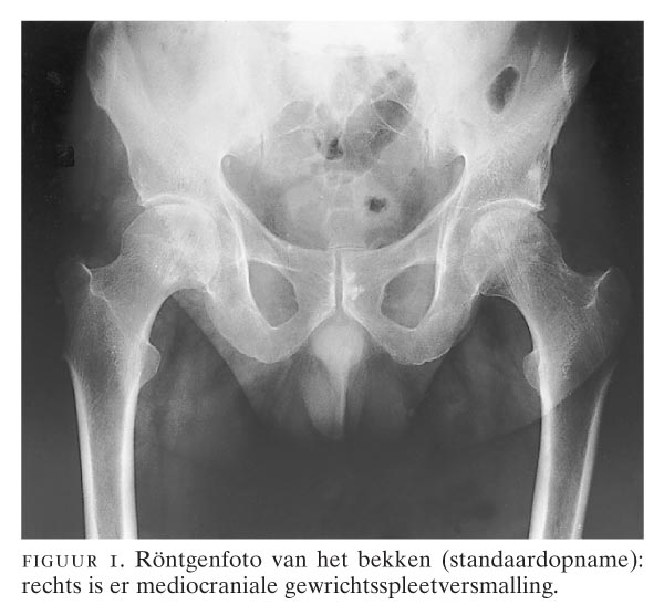 Snel destructieve heupziekte met een ontstoken bursa iliopectinea als ...
