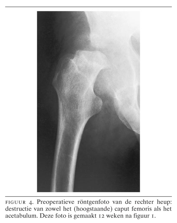 Snel destructieve heupziekte met een ontstoken bursa iliopectinea als ...