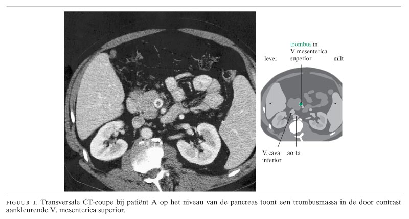 Twee patiënten met koorts, koude rillingen en pijn rechts in de ...