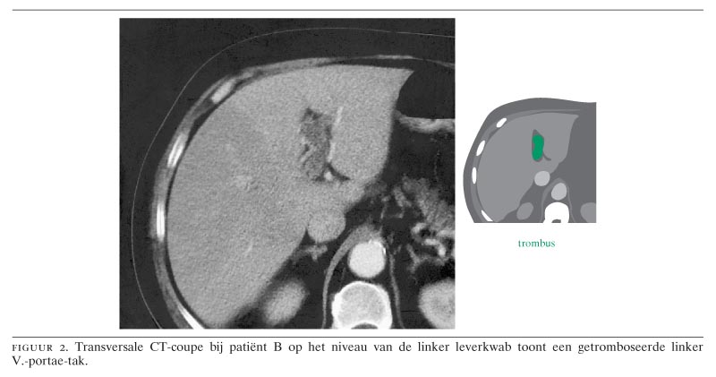 Twee patiënten met koorts, koude rillingen en pijn rechts in de ...