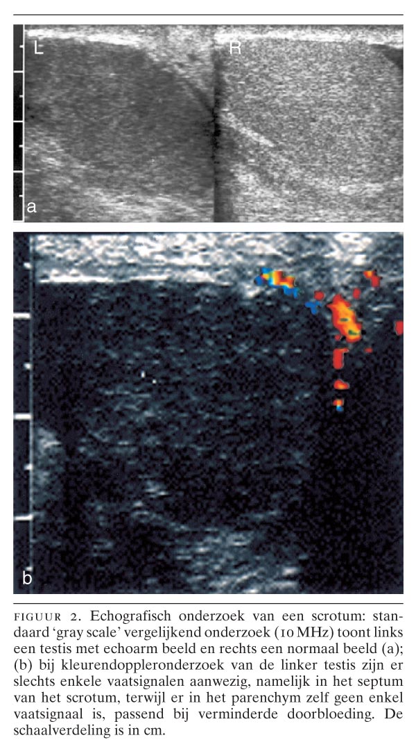 Torsio testis ook mogelijk bij volwassen mannen | NTvG