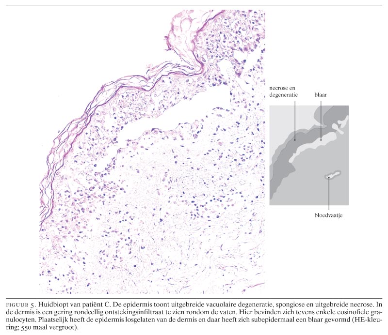 Erythema multiforme versus Stevens-Johnson-syndroom en toxische ...
