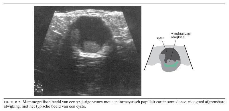 Intracystisch mammacarcinoom: diagnostiek en behandeling in ...