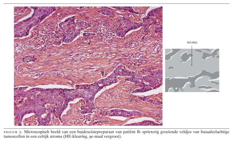 Vijf patiënten met een gemetastaseerd basaalcelcarcinoom | NTVG
