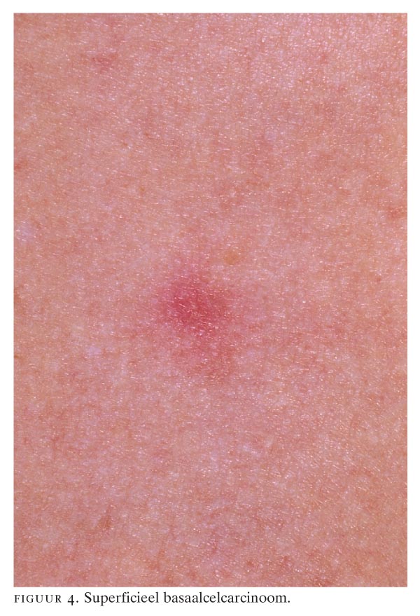 Vijf patiënten met een gemetastaseerd basaalcelcarcinoom | NTVG