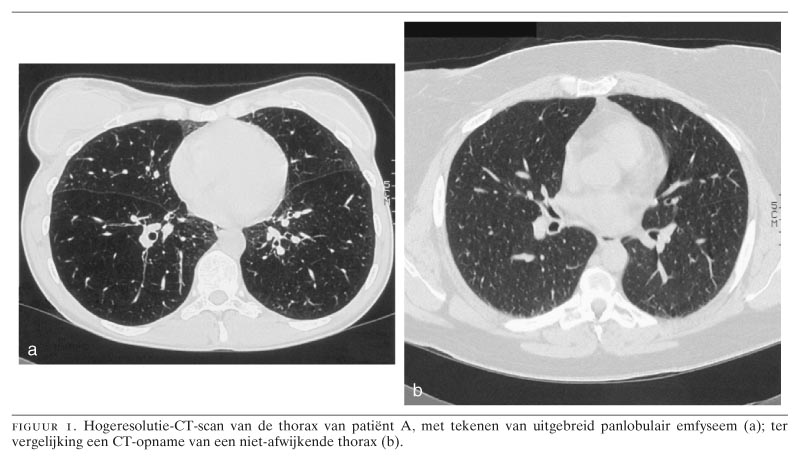 Ernstige chronisch-obstructieve longziekte bij jonge rokende vrouwen ...