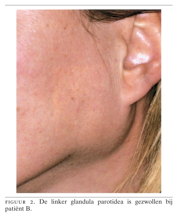 Bilaterale zwelling van de glandulae parotideae als onderdeel van een ...