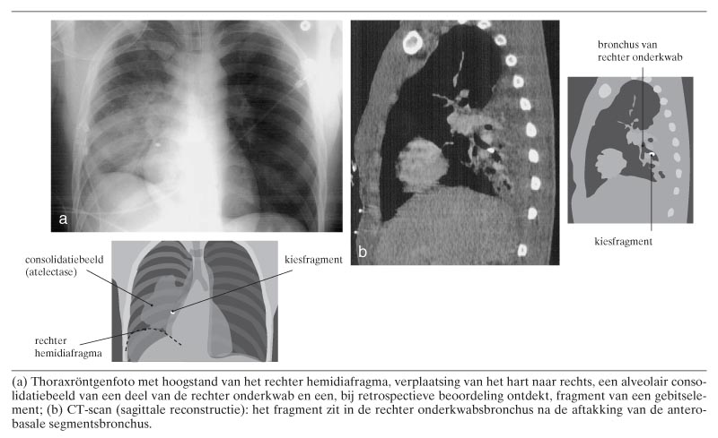 Diagnose in beeld (168). Een man met partiële atelectase na een ongeval ...