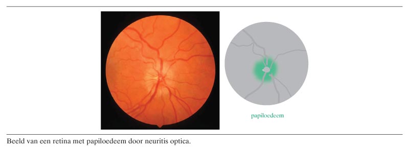 Behandeling van neuritis optica | NTVG