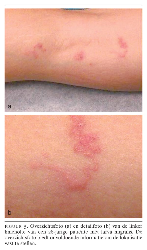 Teledermatologische consultatie | Nederlands Tijdschrift voor Geneeskunde