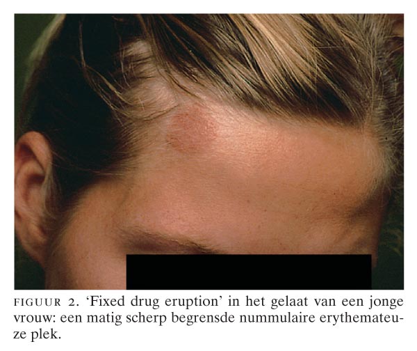 Huidreacties door geneesmiddelen | NTVG