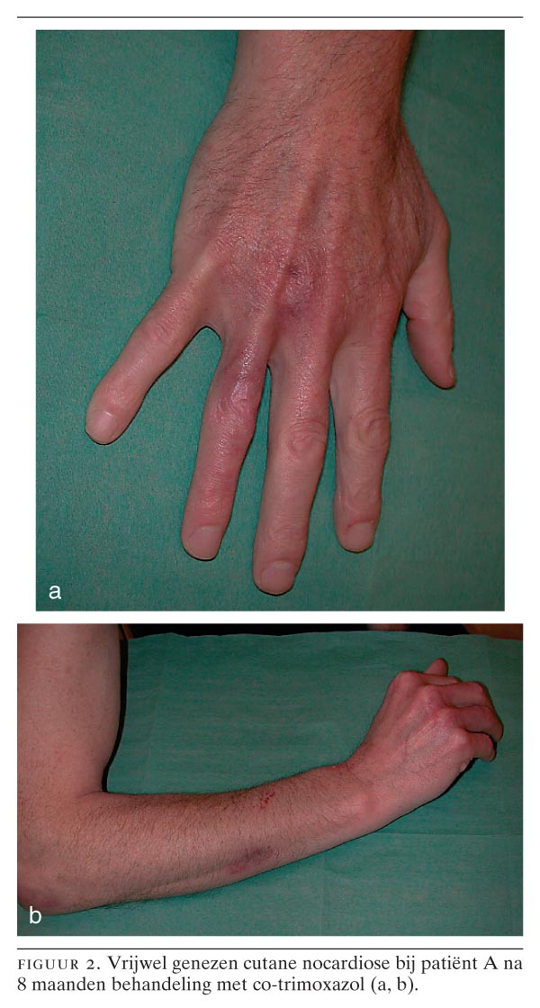 Cutane nocardiose als opportunistische infectie | Nederlands ...