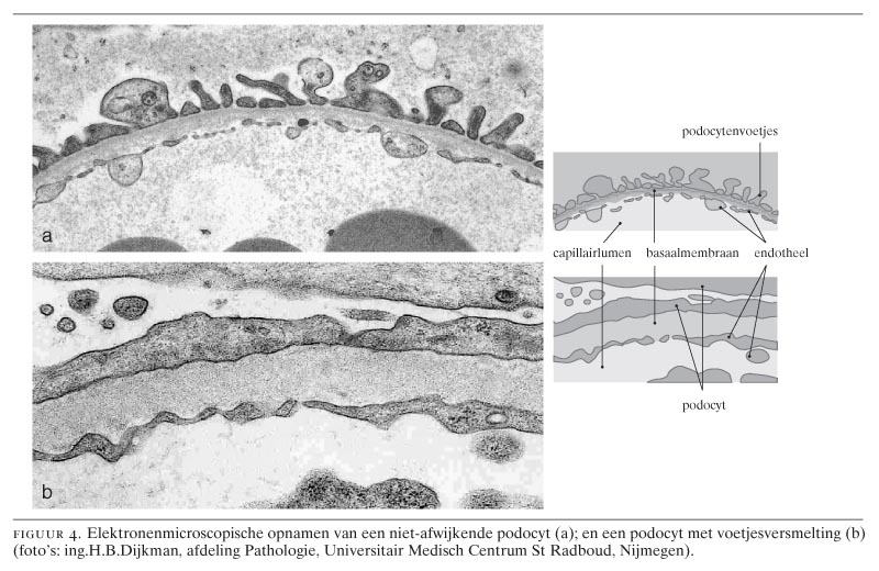 Podocytdisfunctie en proteïnurie | NTVG