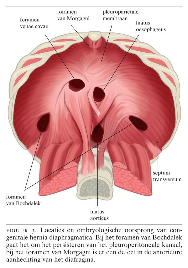 Darmincarceratie door een hernia van Bochdalek | Nederlands Tijdschrift ...